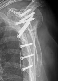 CarboFix "Piccolo" Proximal Humeral Plate - Ortospine